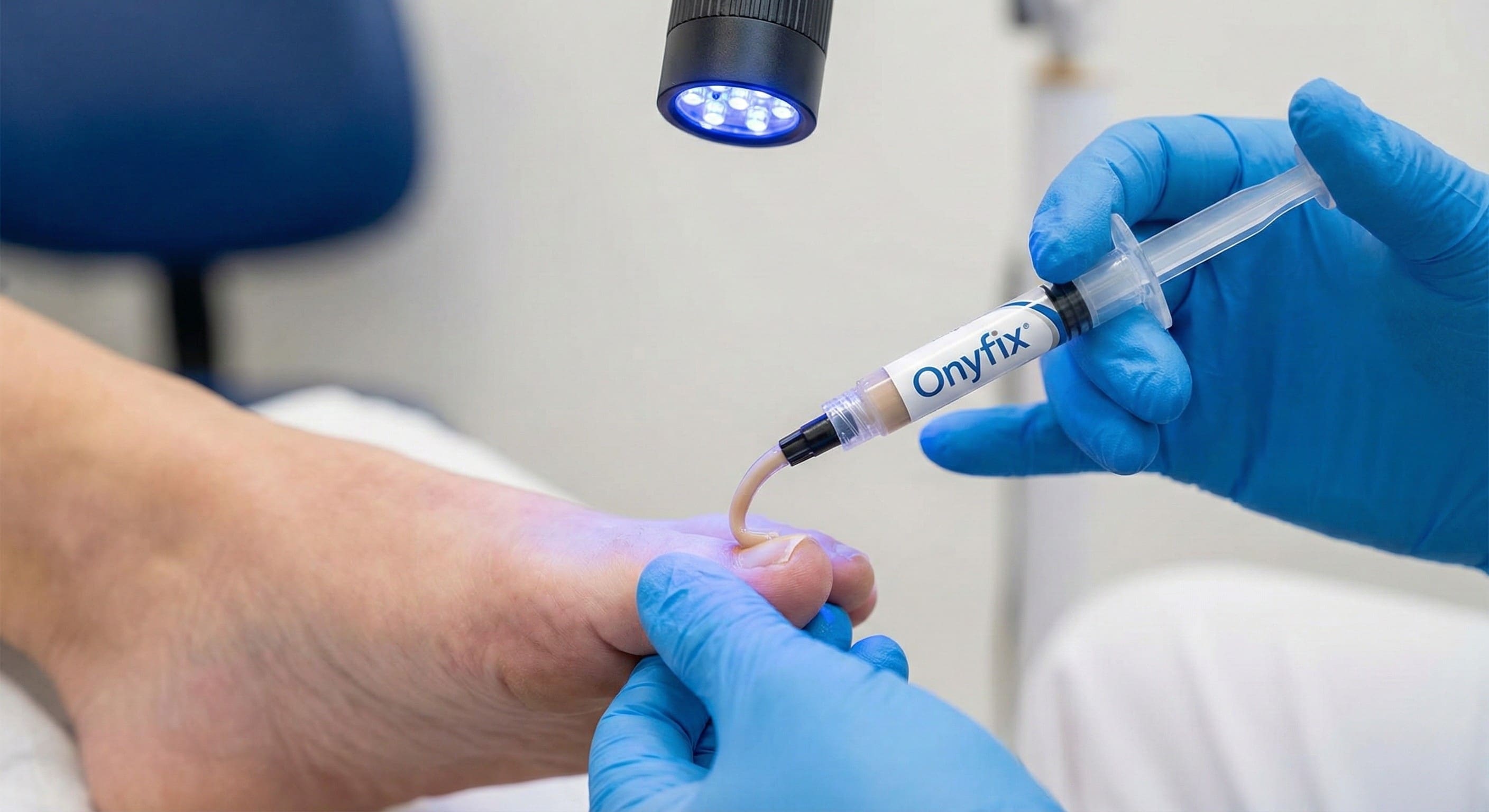 Onyfix Therapy - Non-Surgical Ingrown Toenail Correction